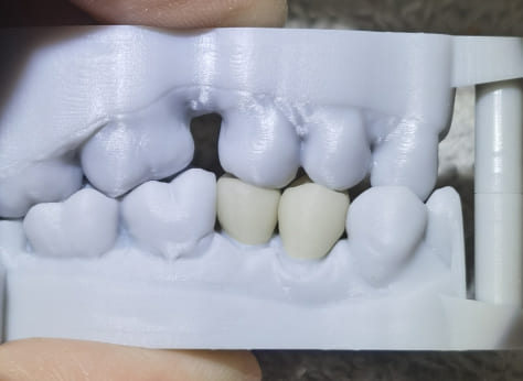 Impression Scanning for Fixed Restorations | HeyGears Dental Solution