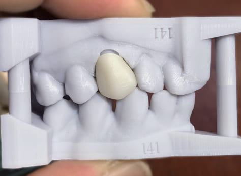 Impression Scanning for Fixed Restorations | HeyGears Dental Solution